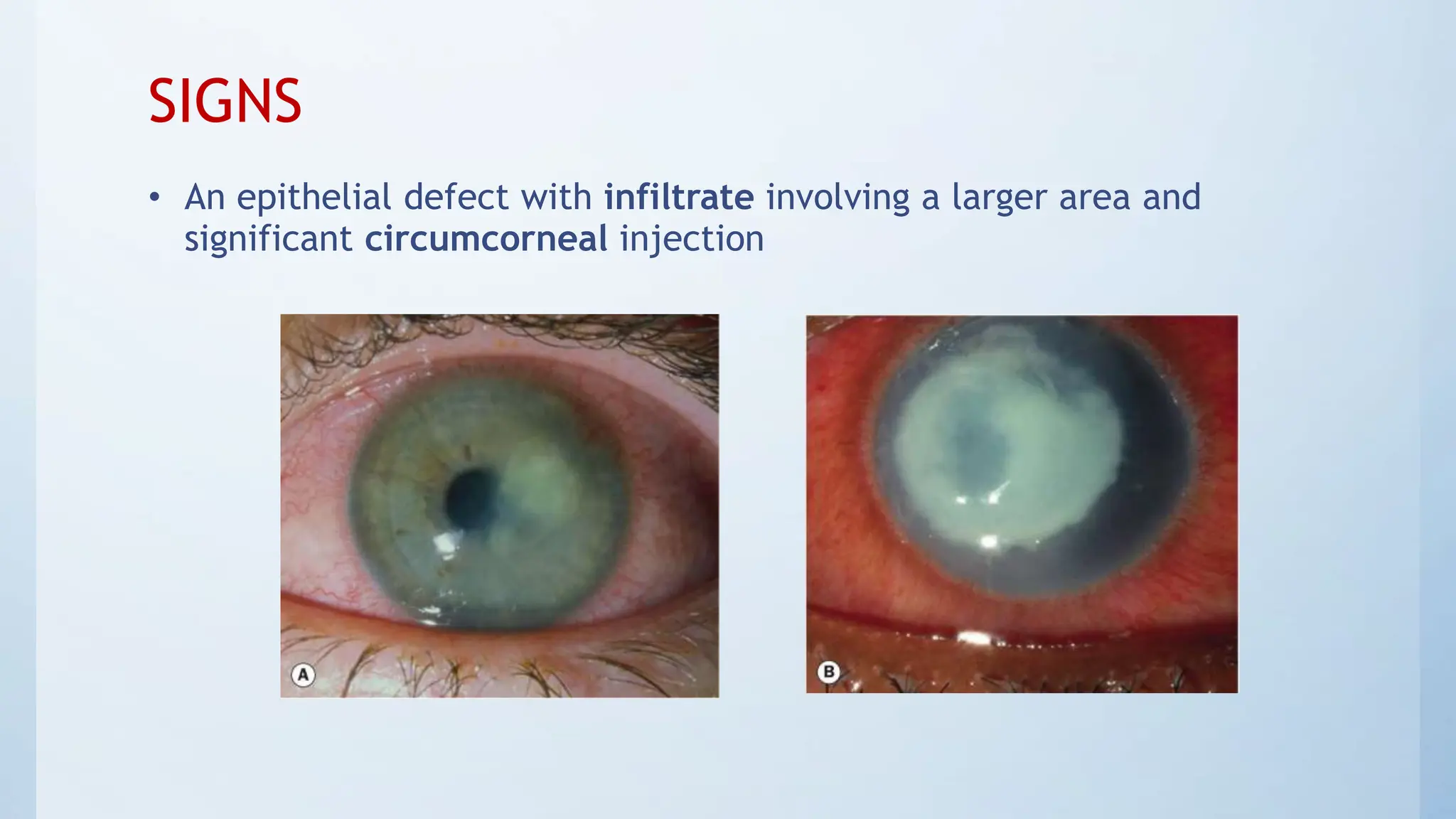 BACTERIAL KERATITIS POWERPOINT PRESENTATION | PPTX