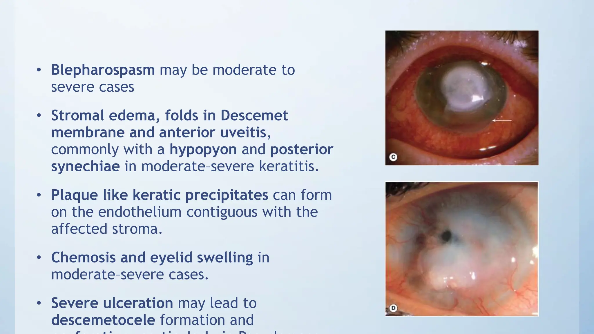 BACTERIAL KERATITIS POWERPOINT PRESENTATION | PPTX