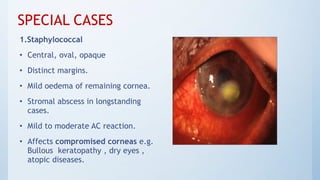 BACTERIAL KERATITIS POWERPOINT PRESENTATION | PPTX