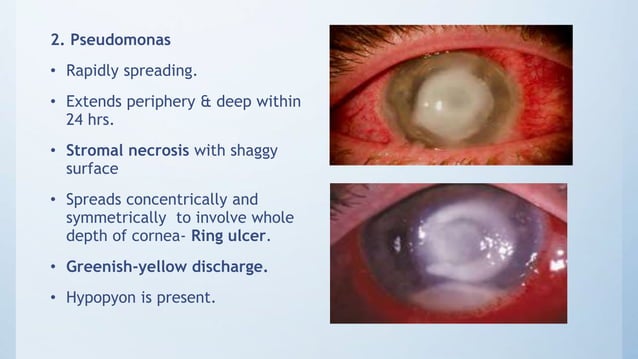 BACTERIAL KERATITIS POWERPOINT PRESENTATION | PPTX