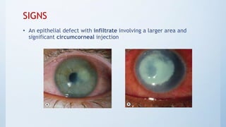 BACTERIAL KERATITIS POWERPOINT PRESENTATION | PPTX