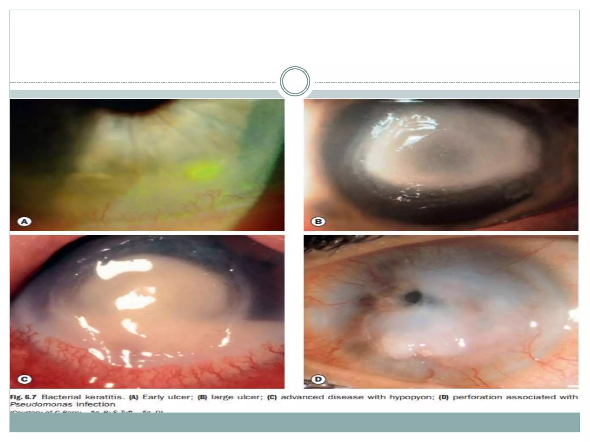 Bacterial keratitis | PPTX | Eye and Vision Conditions | Diseases and ...