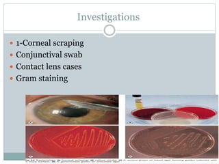 Bacterial keratitis | PPTX | Eye and Vision Conditions | Diseases and ...