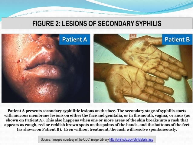 Bacterial lesion by Dr. Gaurav Salunkhe