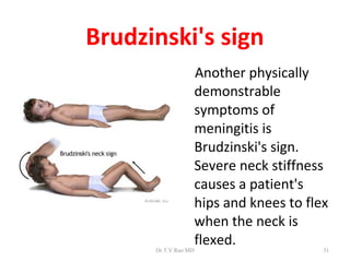 Bacterial meningitis | PPT
