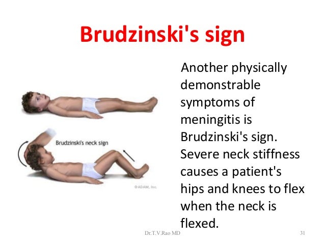 Bacterial meningitis