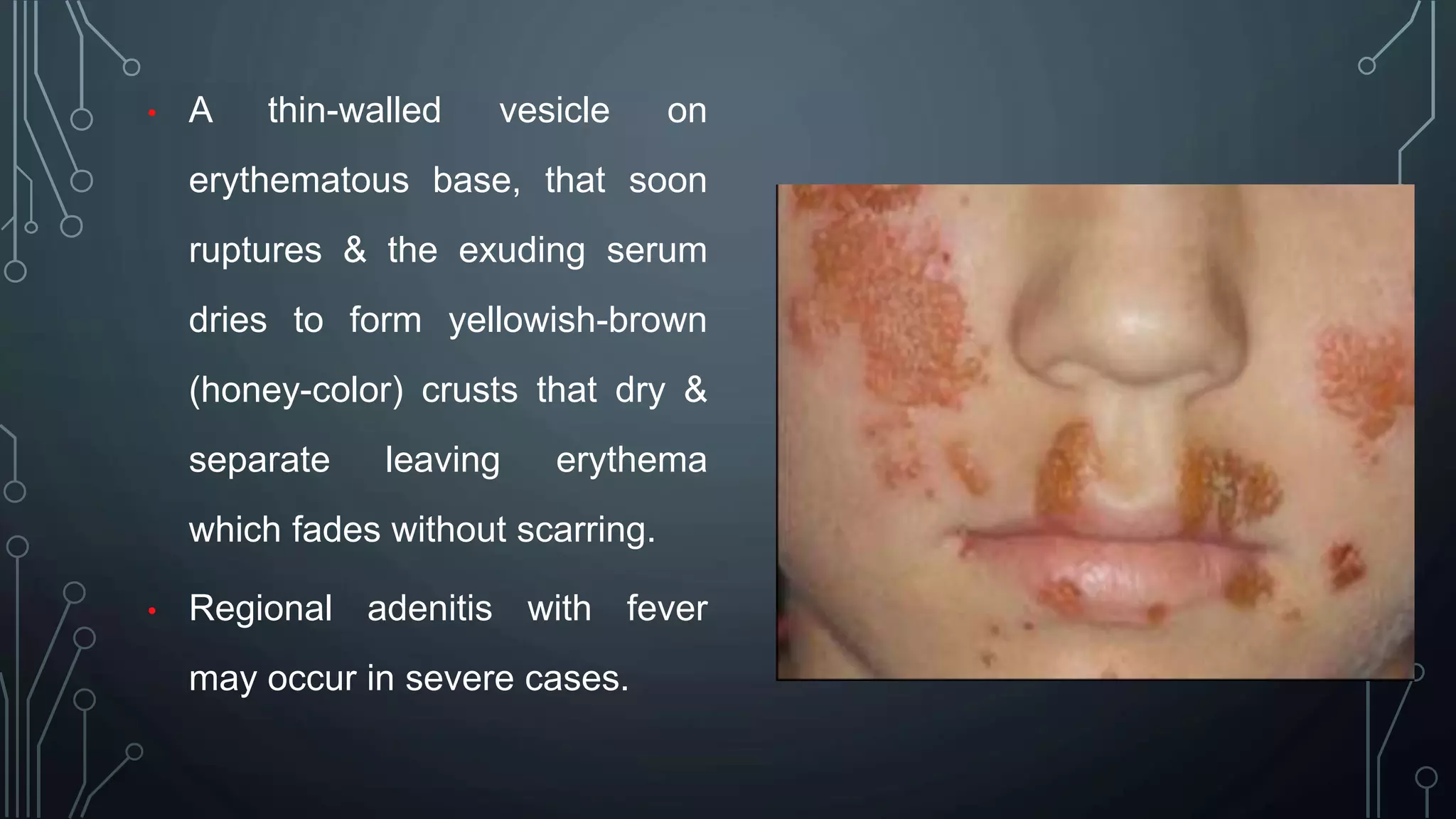 Bacterial skin infection- dermatology | PPTX