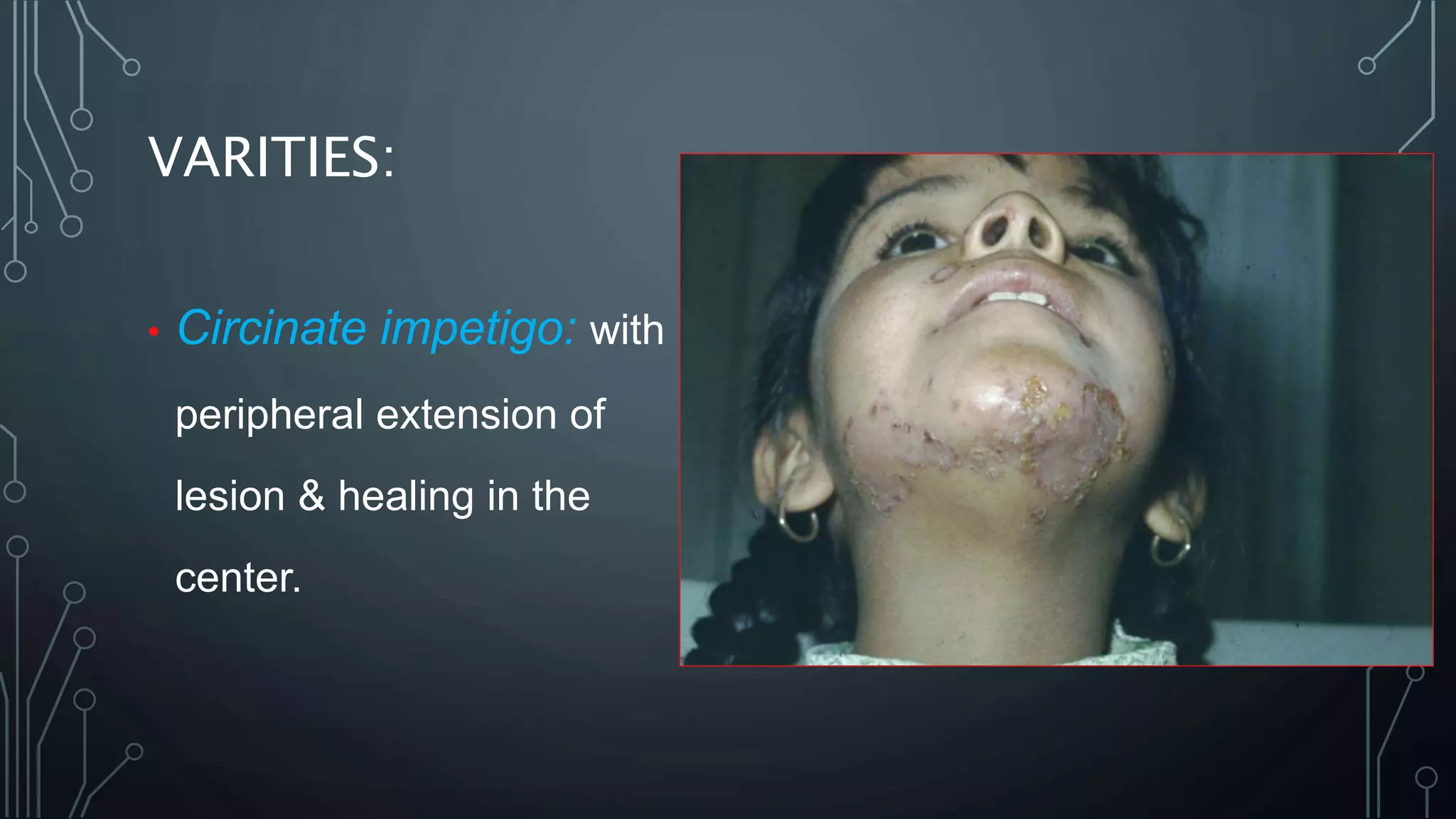 Bacterial Skin Infection Dermatology Ppt
