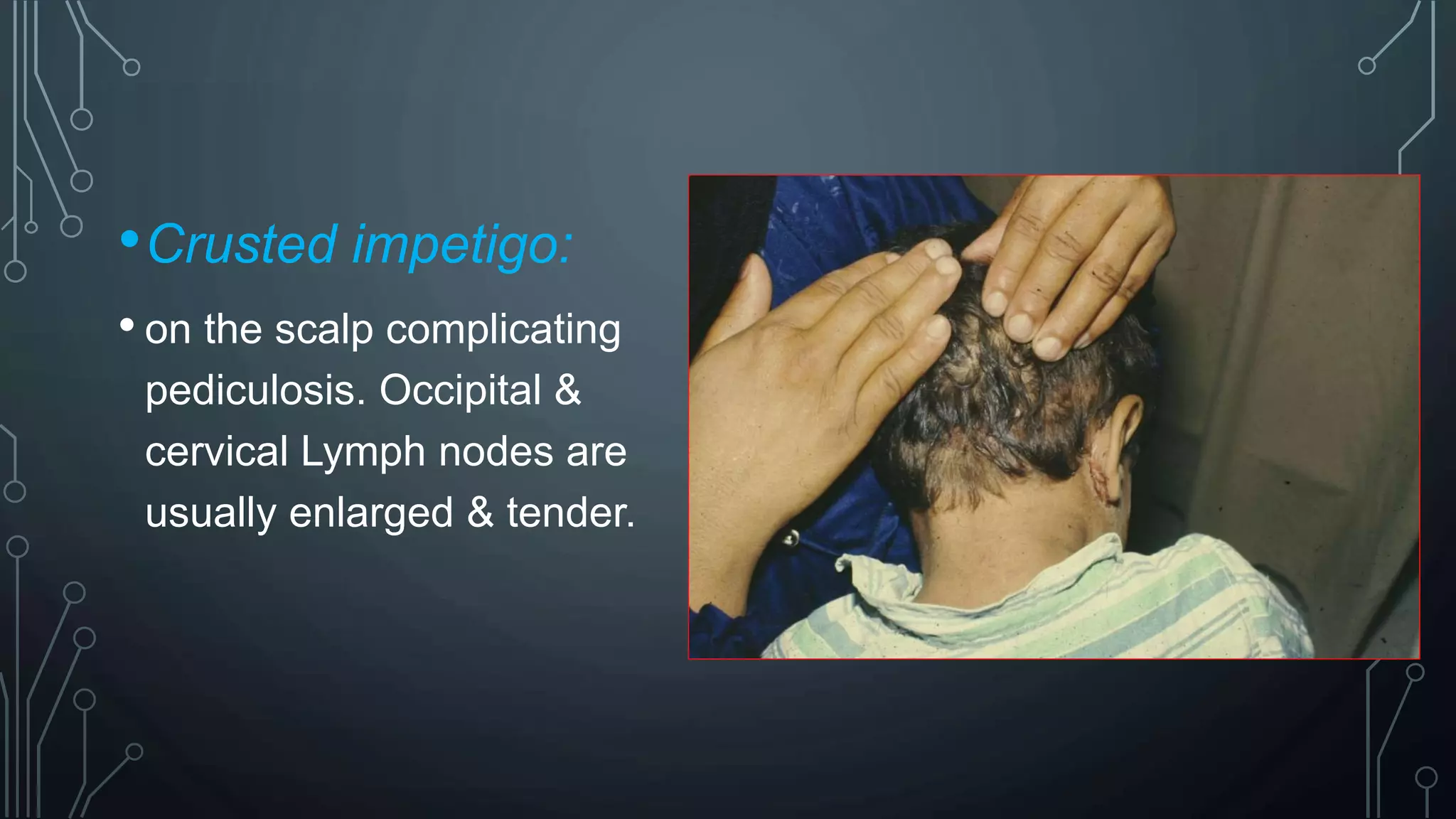 Bacterial skin infection- dermatology | PPTX