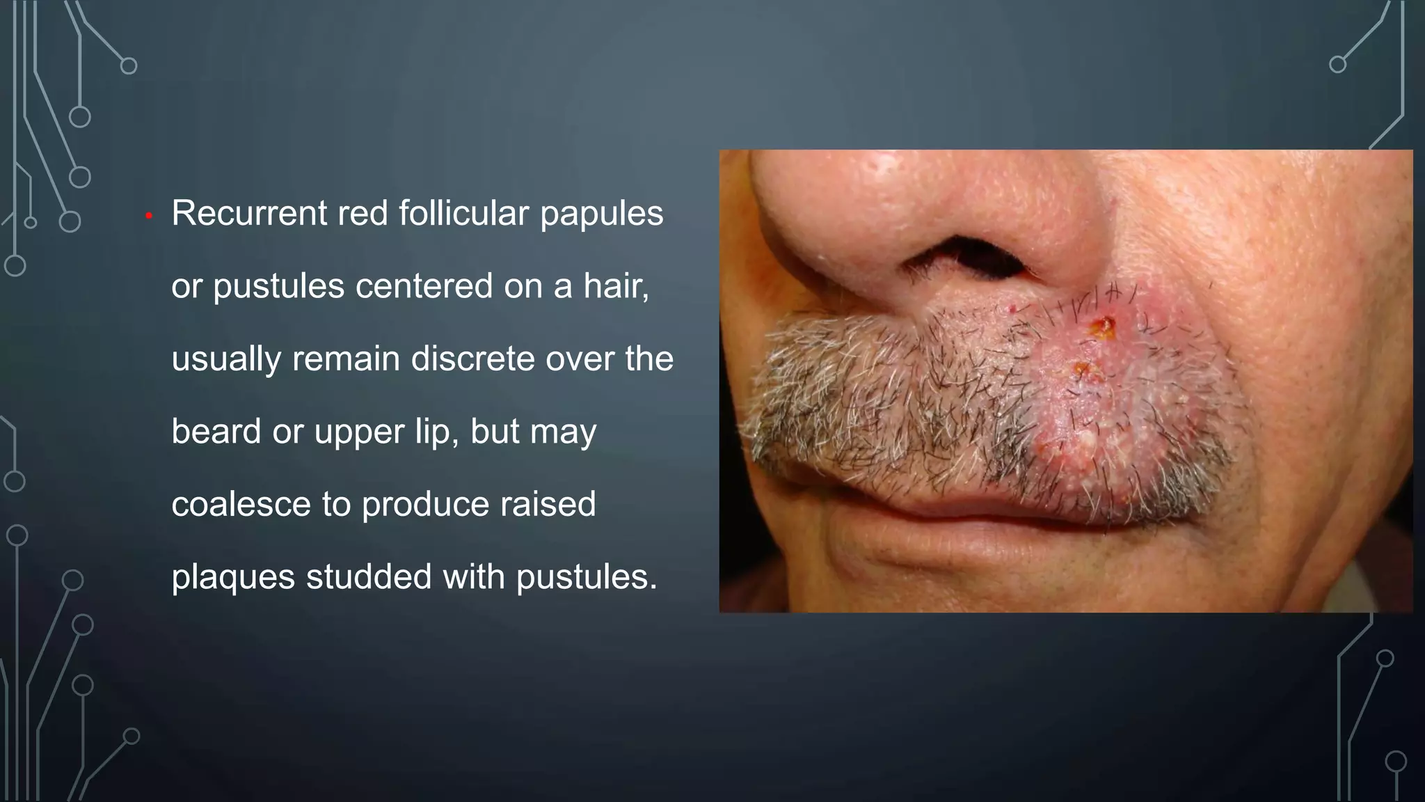 Bacterial skin infection- dermatology | PPTX