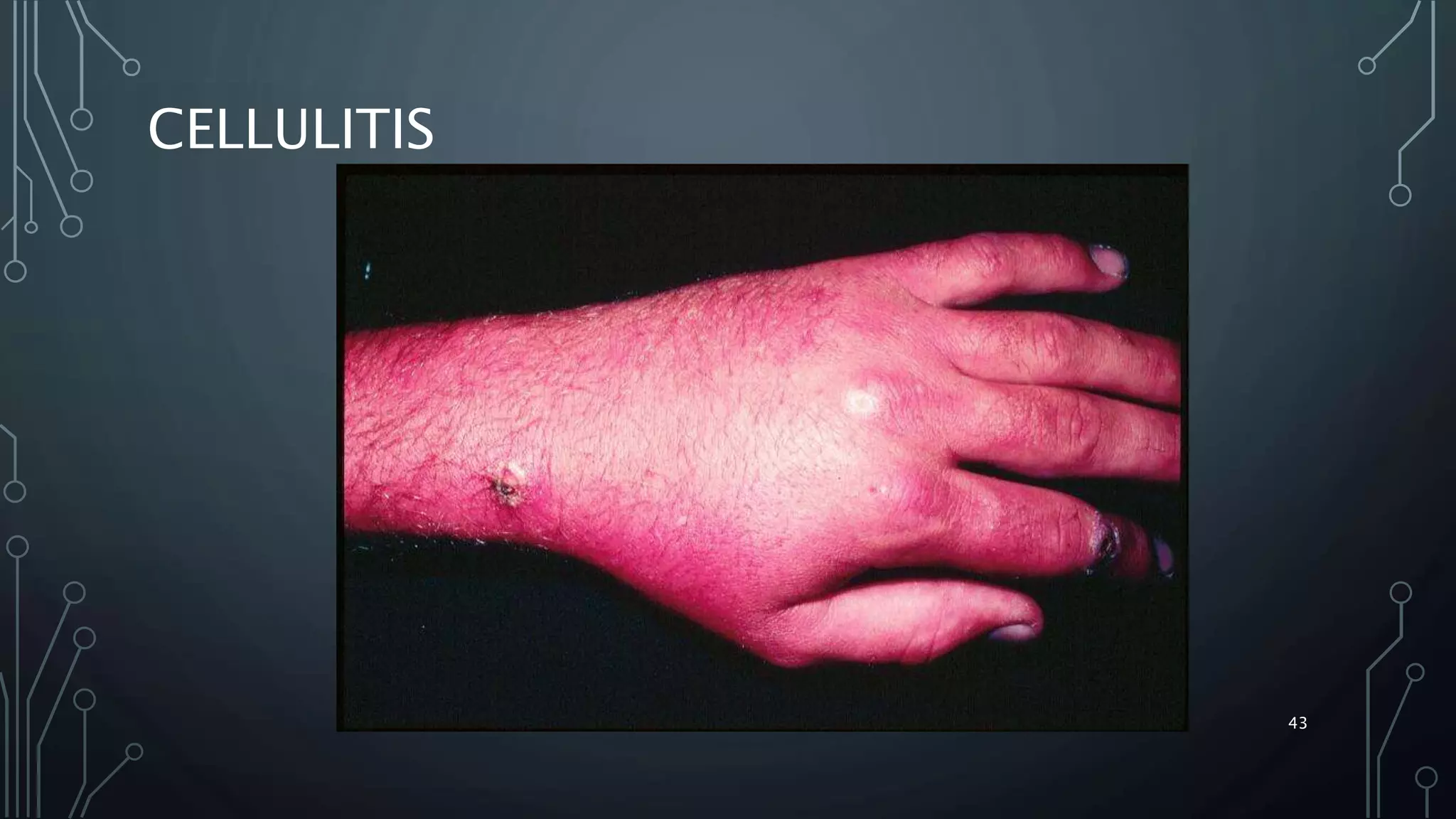 Bacterial skin infection- dermatology | PPTX