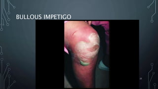 Bacterial skin infection- dermatology | PPTX
