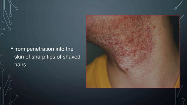 Bacterial skin infection- dermatology | PPTX