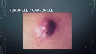 Bacterial skin infection- dermatology | PPTX