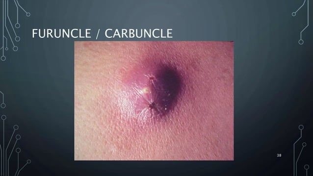 Bacterial skin infection- dermatology | PPTX