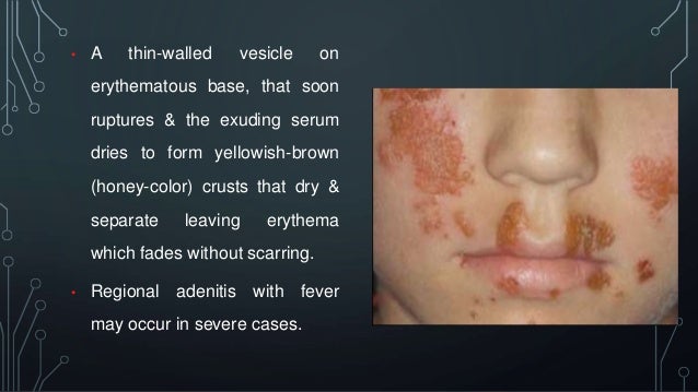Bacterial skin infection- dermatology
