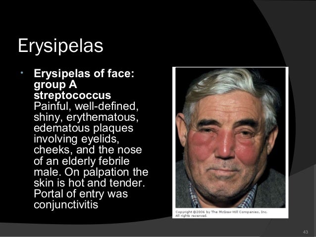 Erysipelas Children