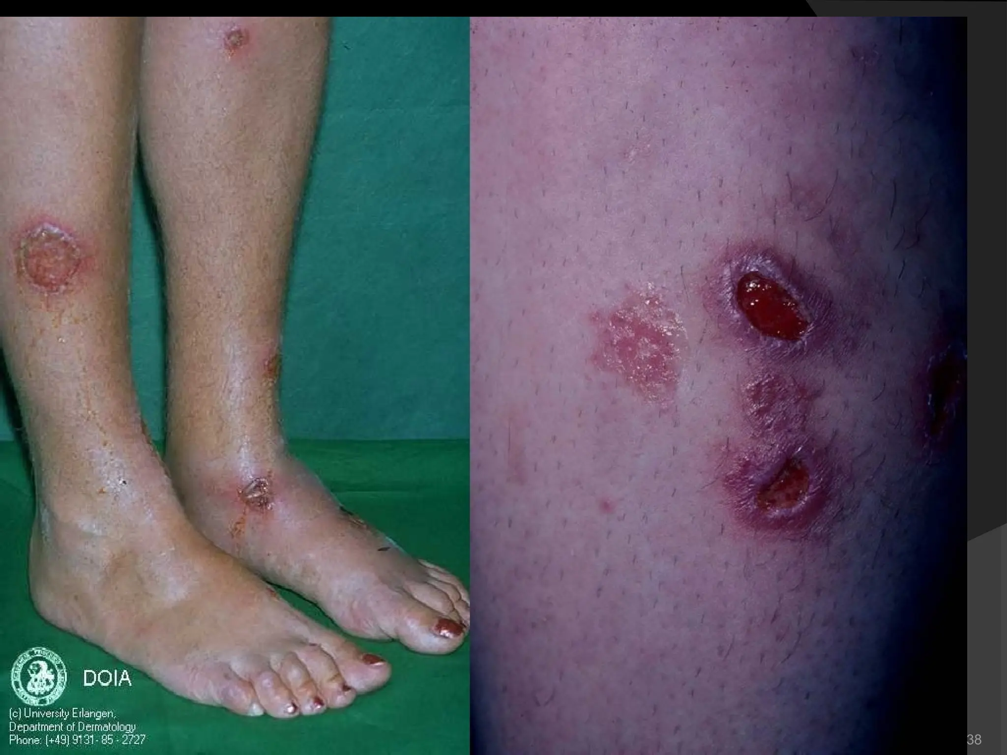 bacterial skin infections class.pptx Detailed | PPT | Free Download