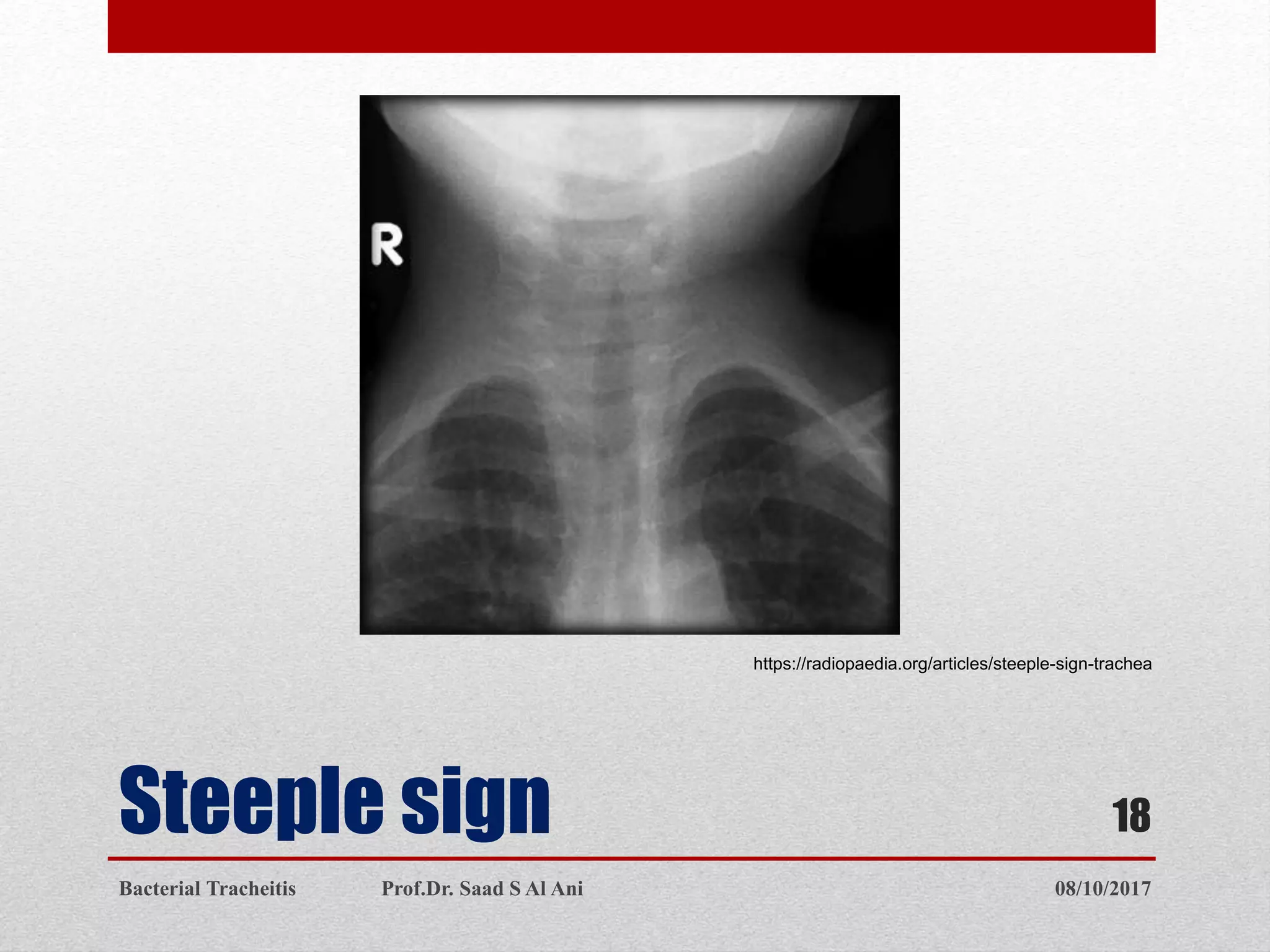 Bacterial tracheitis | PPTX