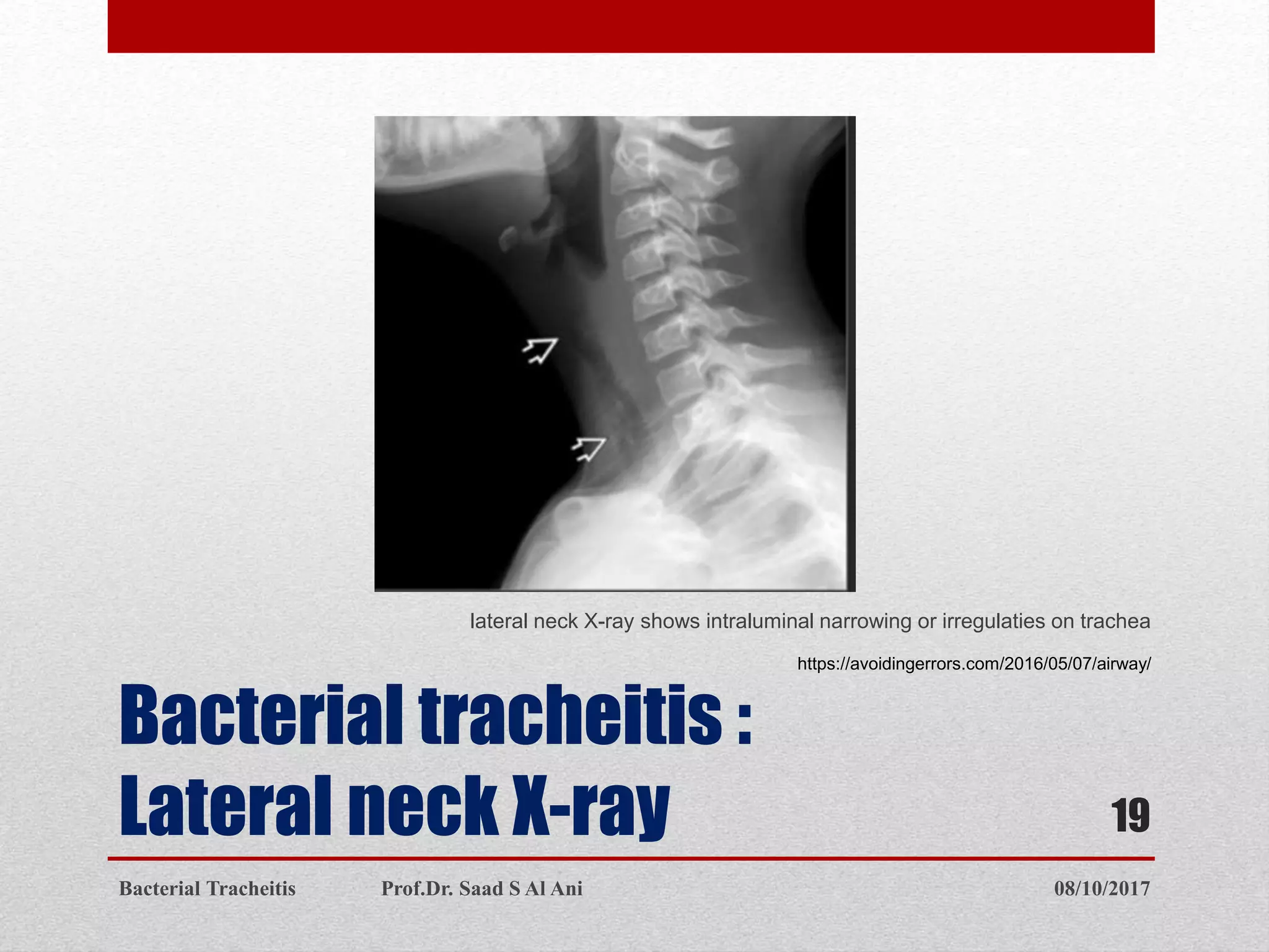 Bacterial tracheitis | PPTX