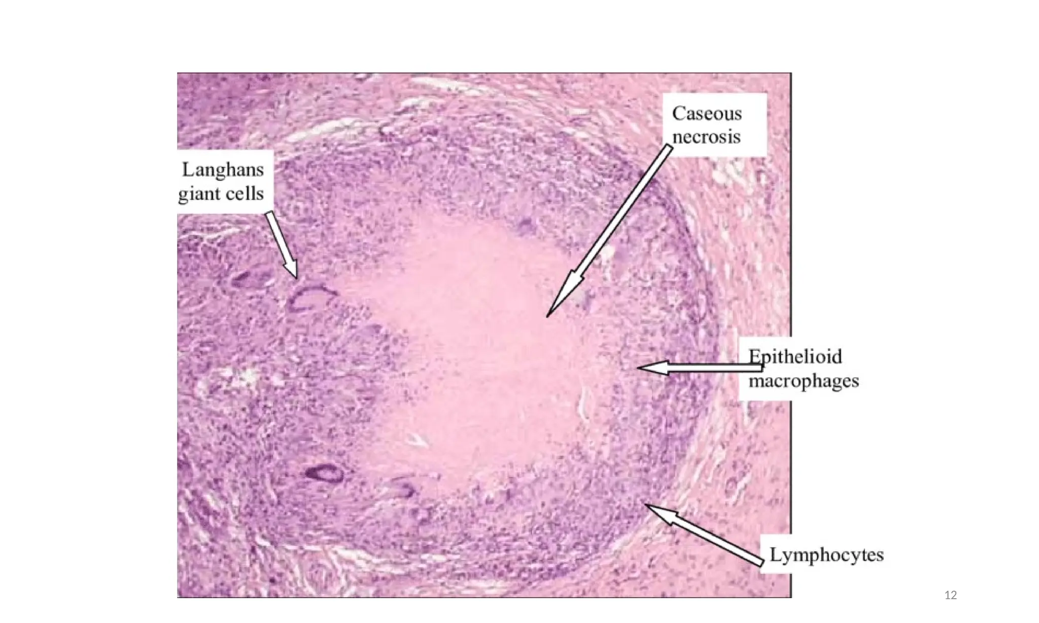 Bacterial uveitis (Tuberculosis - Anterior- Posterior manifestation) | PPTX