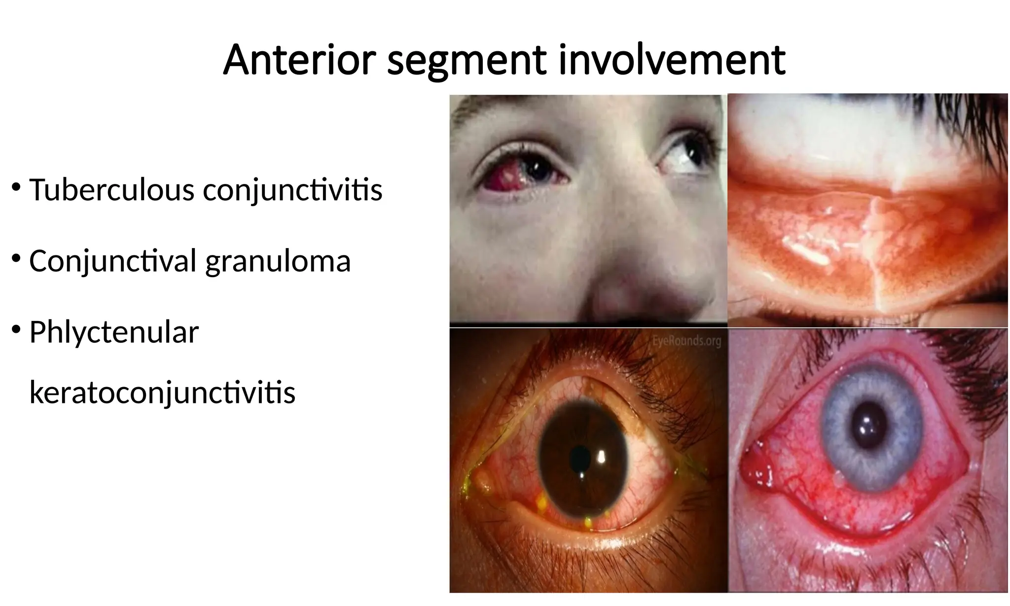 Bacterial uveitis (Tuberculosis - Anterior- Posterior manifestation) | PPTX