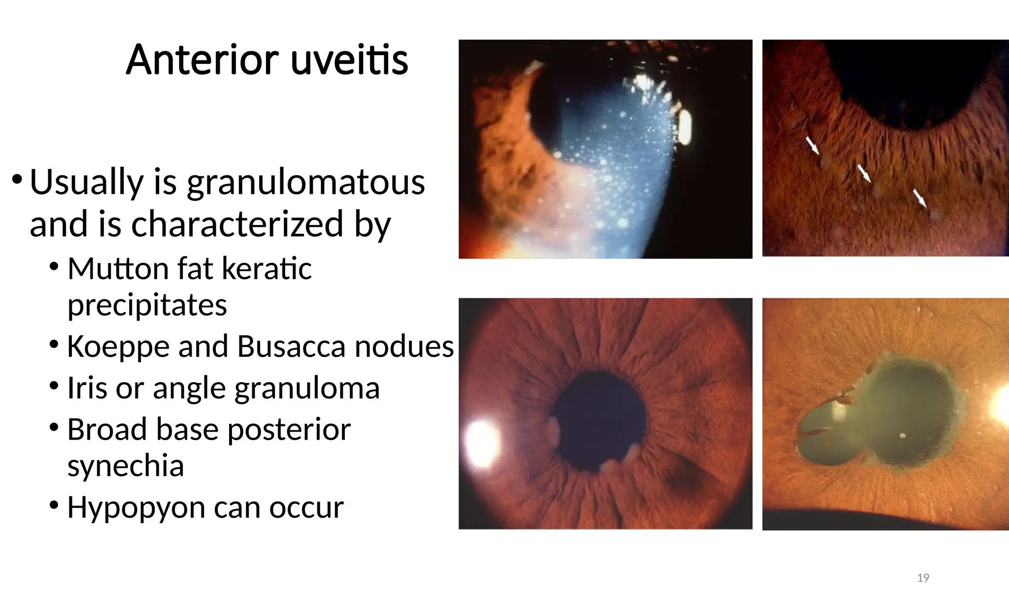Bacterial uveitis (Tuberculosis - Anterior- Posterior manifestation) | PPTX