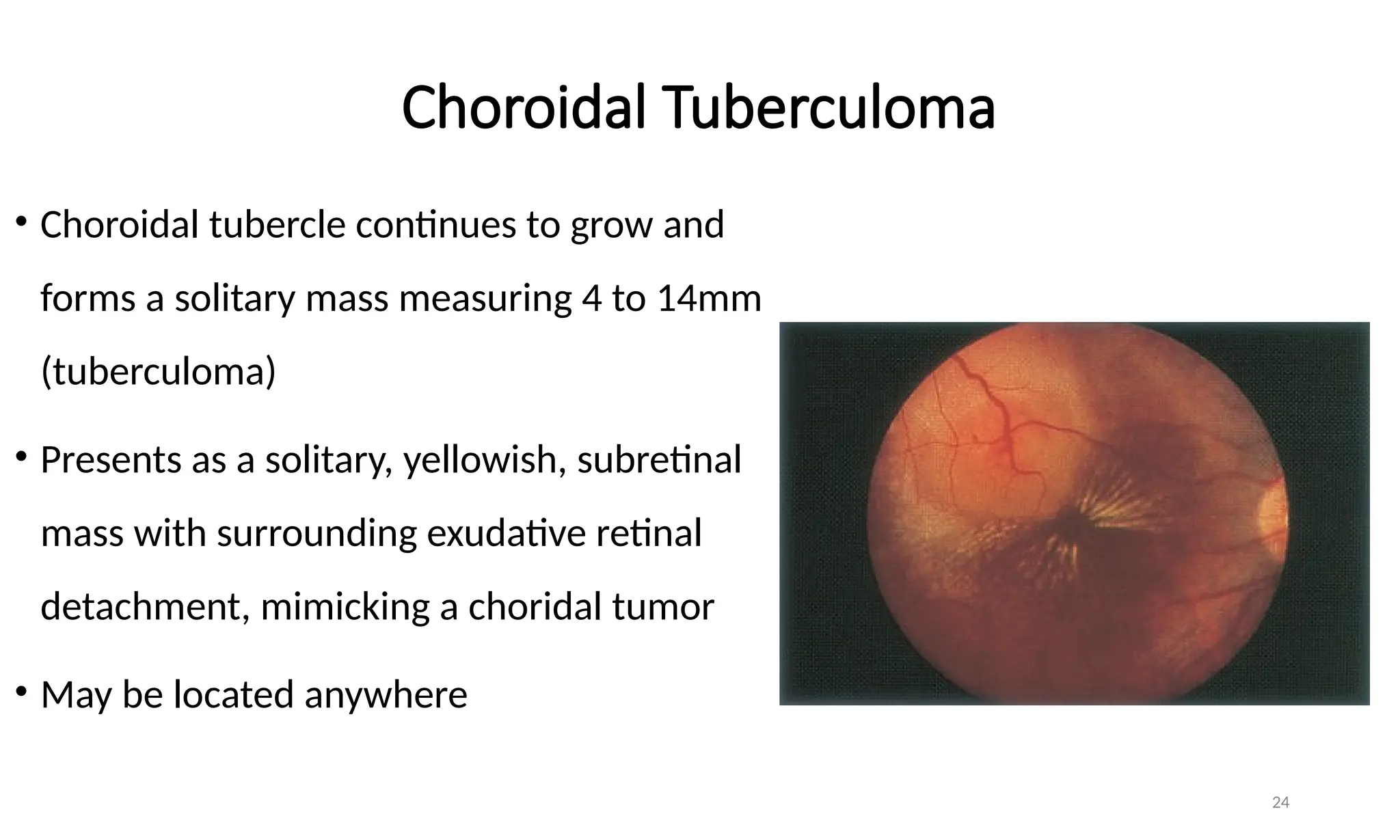 Bacterial uveitis (Tuberculosis - Anterior- Posterior manifestation) | PPTX