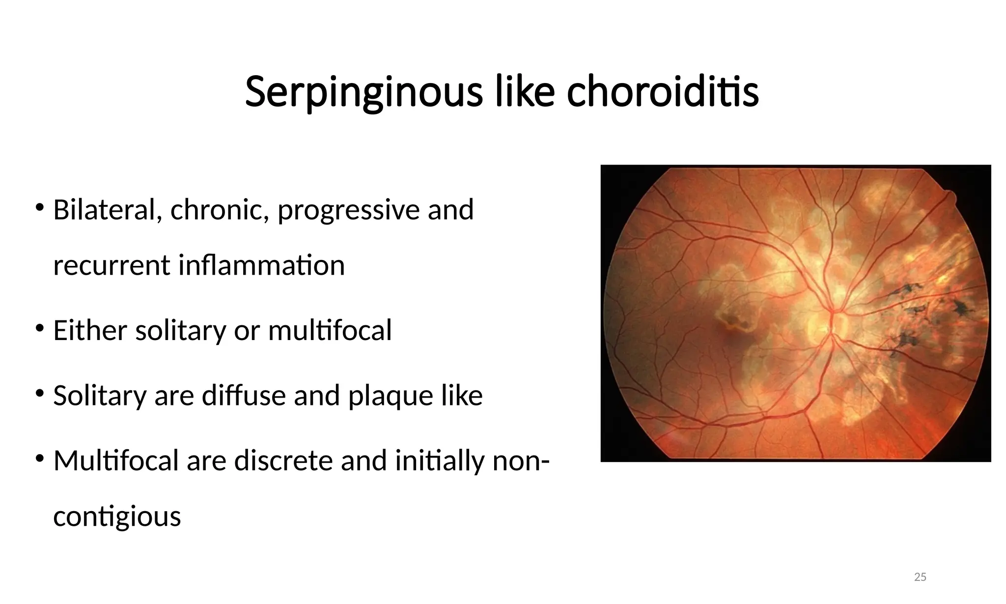 Bacterial uveitis (Tuberculosis - Anterior- Posterior manifestation) | PPTX