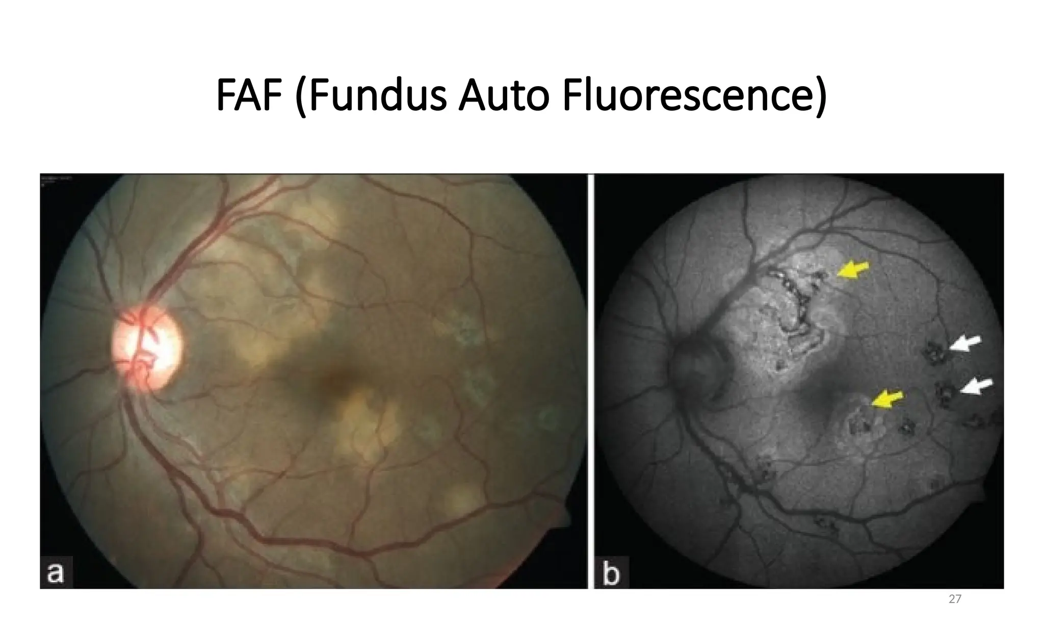 Bacterial uveitis (Tuberculosis - Anterior- Posterior manifestation) | PPTX