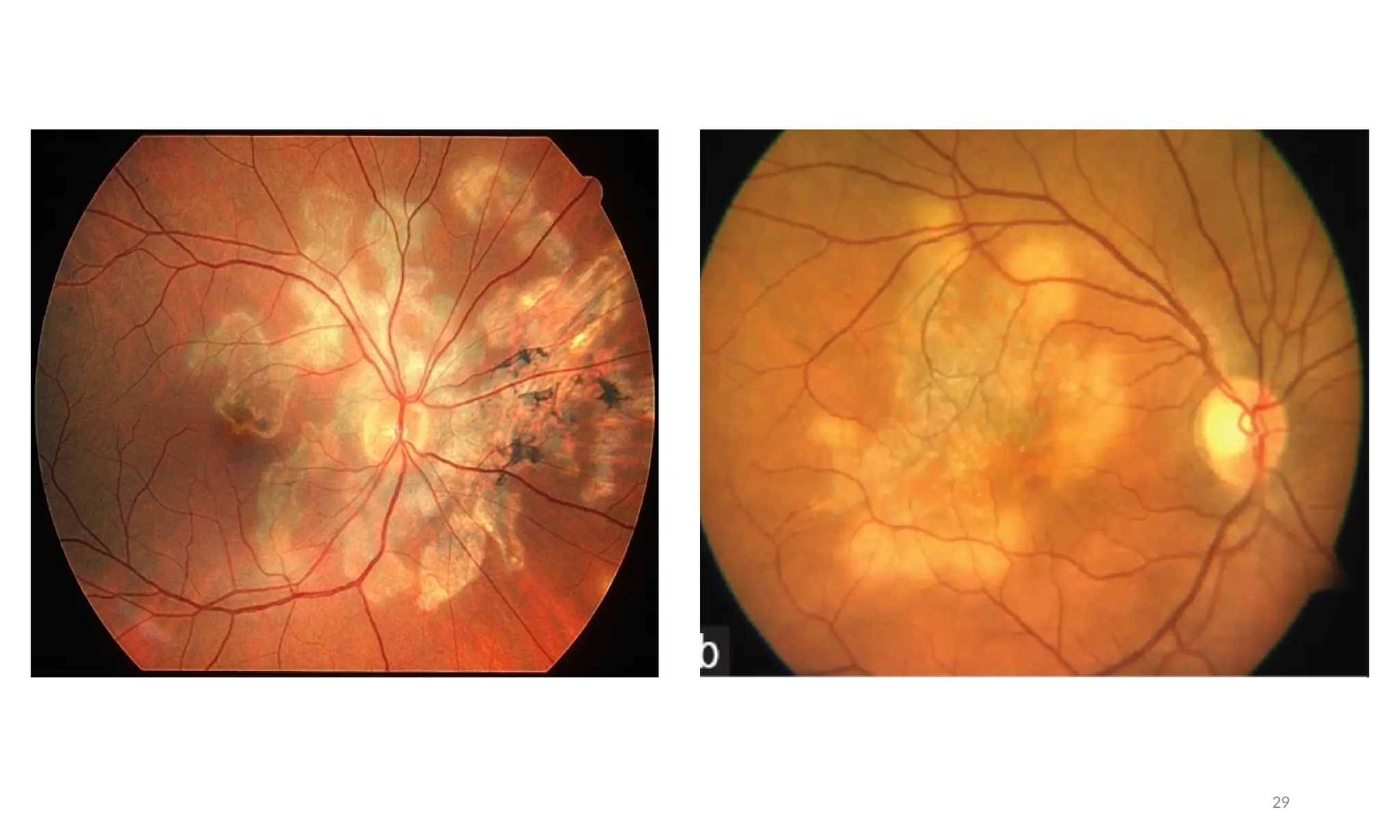 Bacterial uveitis (Tuberculosis - Anterior- Posterior manifestation) | PPTX