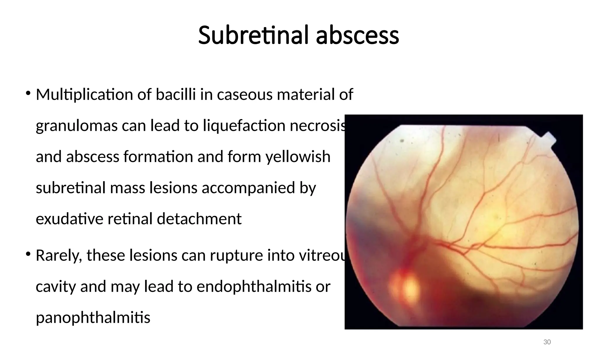 Bacterial uveitis (Tuberculosis - Anterior- Posterior manifestation) | PPTX