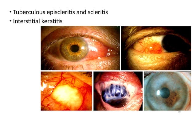 Bacterial uveitis (Tuberculosis - Anterior- Posterior manifestation) | PPTX
