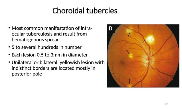 Bacterial uveitis (Tuberculosis - Anterior- Posterior manifestation) | PPTX