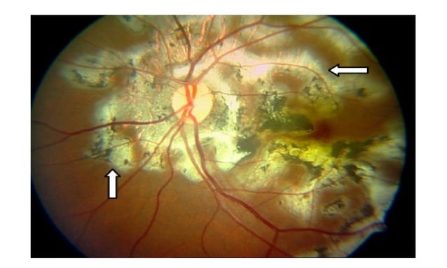Bacterial uveitis (Tuberculosis - Anterior- Posterior manifestation) | PPTX