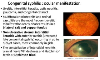 Bacterial uveitis (Tuberculosis - Anterior- Posterior manifestation) | PPTX