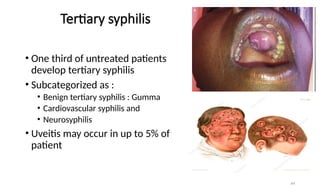 Bacterial uveitis (Tuberculosis - Anterior- Posterior manifestation) | PPTX