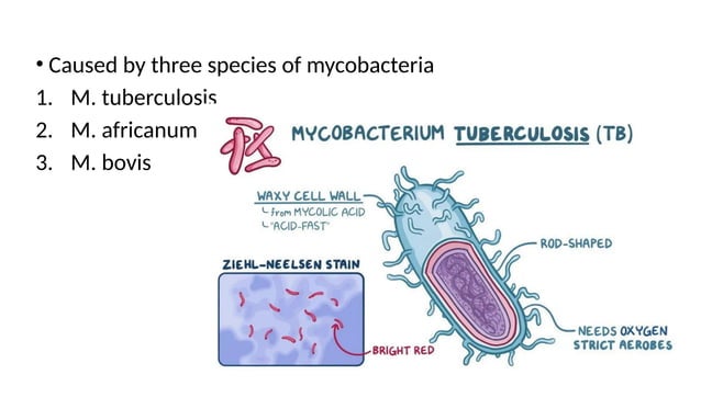Bacterial uveitis (Tuberculosis - Anterior- Posterior manifestation) | PPTX