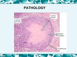 Bacterial uveitis | PPTX
