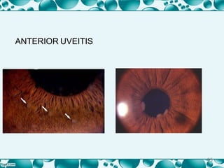 Bacterial uveitis | PPTX
