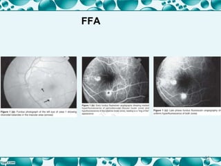 Bacterial uveitis | PPTX