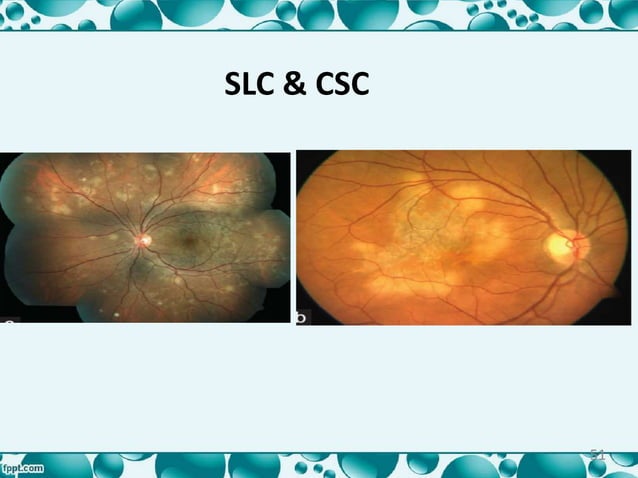 Bacterial uveitis | PPTX