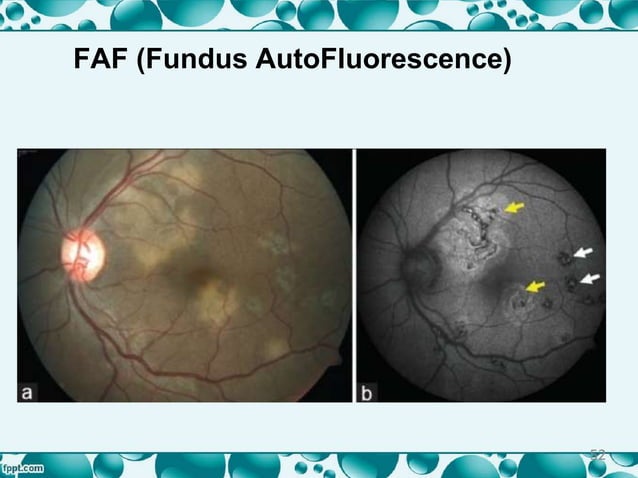 Bacterial uveitis | PPTX