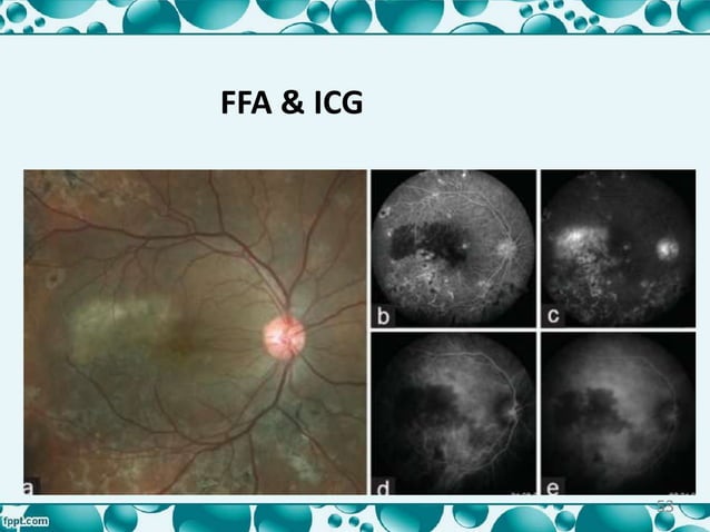 Bacterial uveitis | PPTX