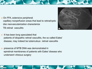 Bacterial uveitis | PPTX