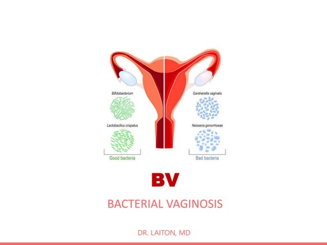Bacterial Vaginosis.pptx | Sexual Conditions | Sexual Health