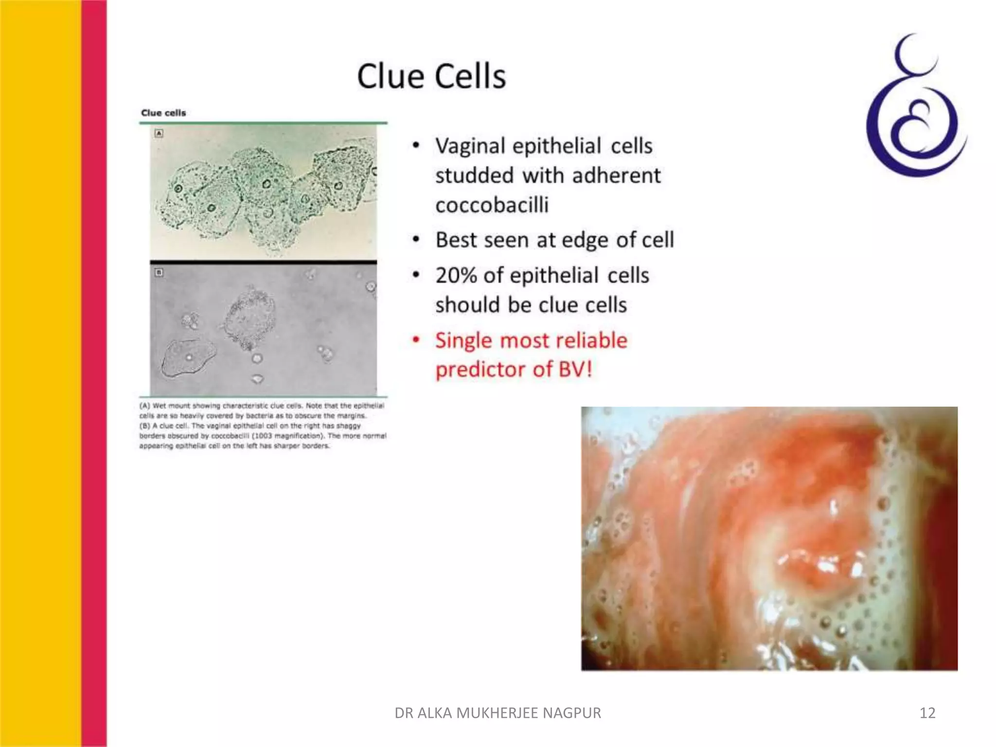 Bacterial vaginosis by dr alka mukherjee DR APURVA MUKHERJEE nagpur m.s ...