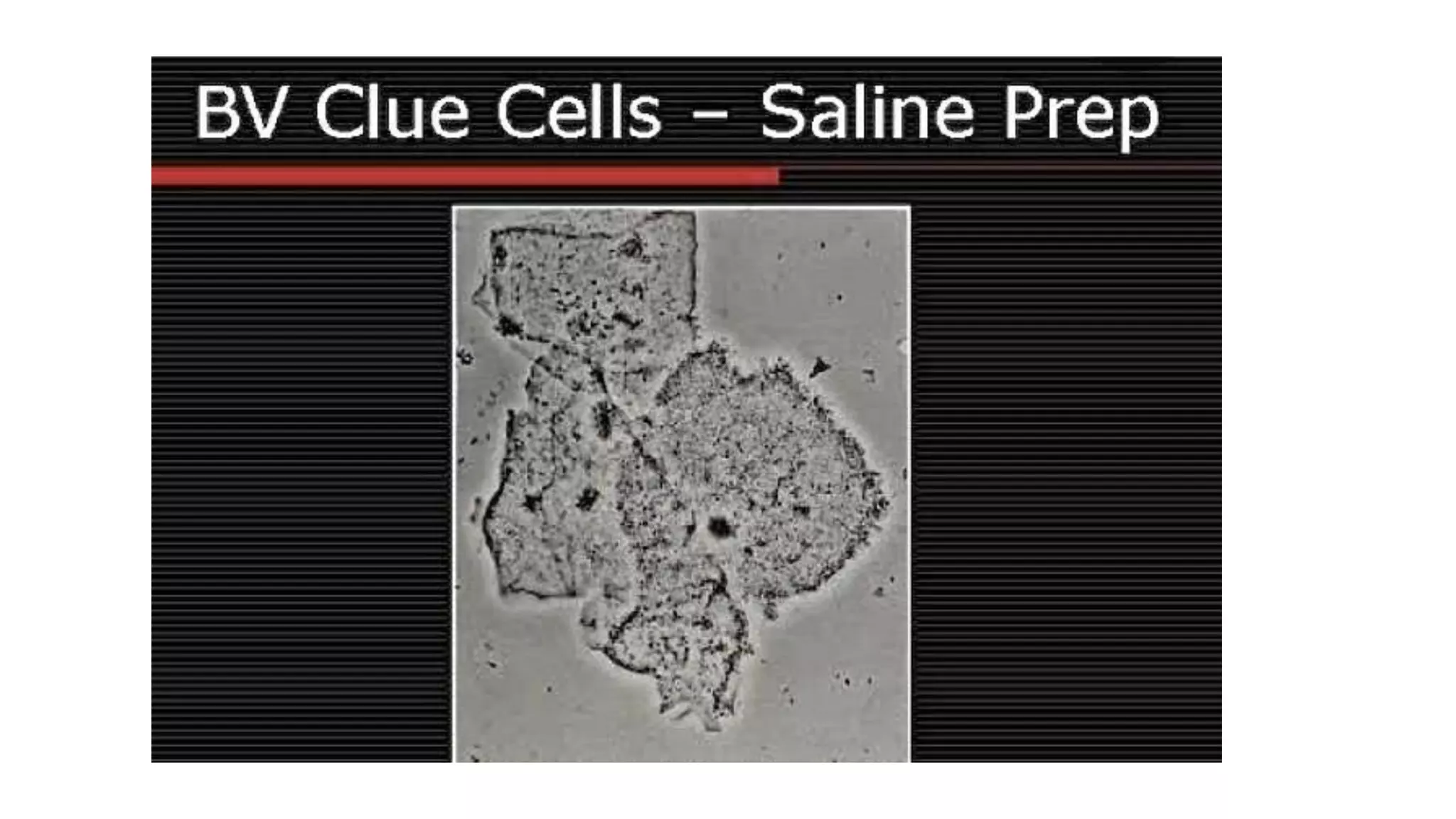 BACTERIAL VAGINOSIS final.pptx