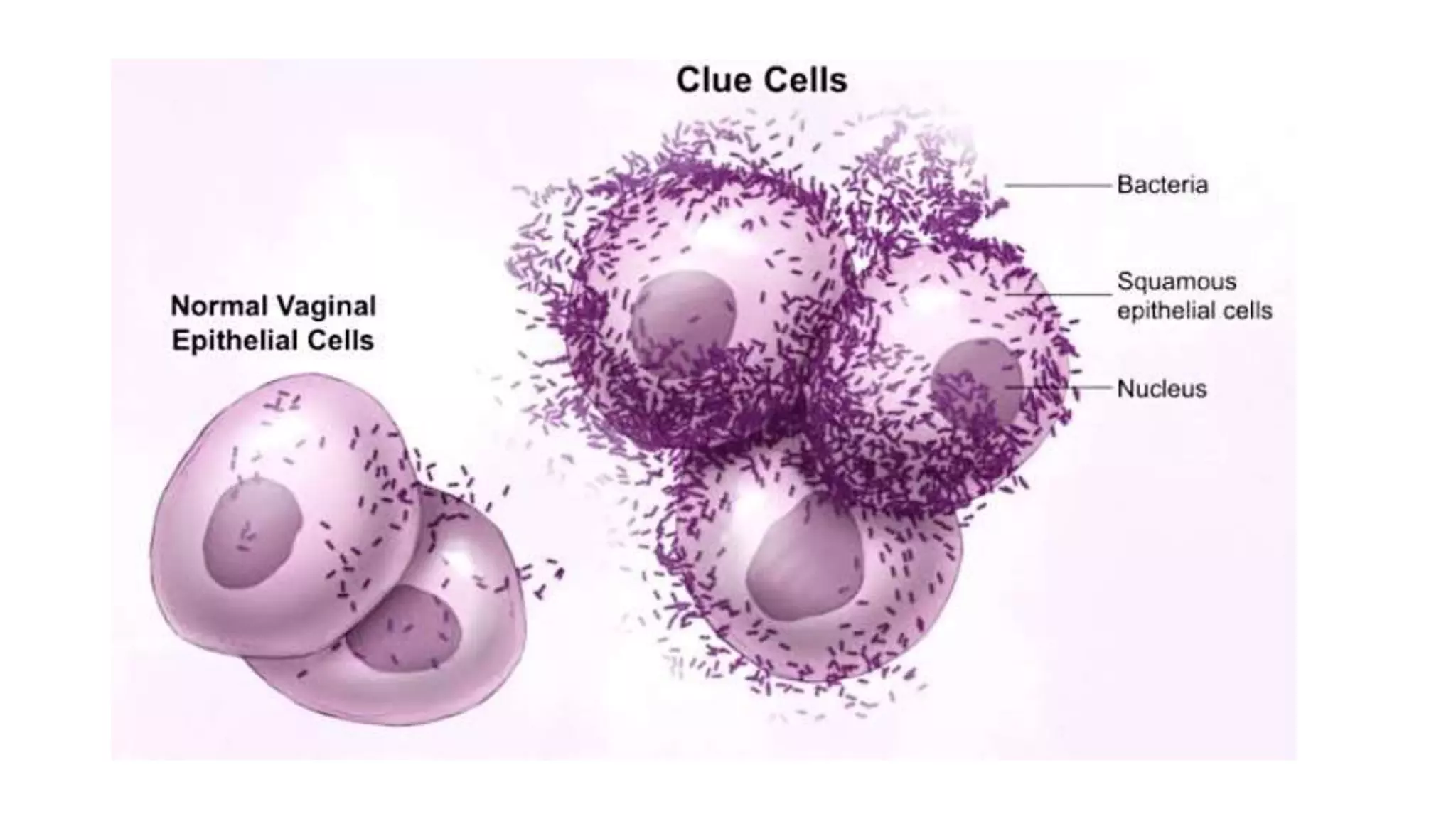 BACTERIAL VAGINOSIS final.pptx