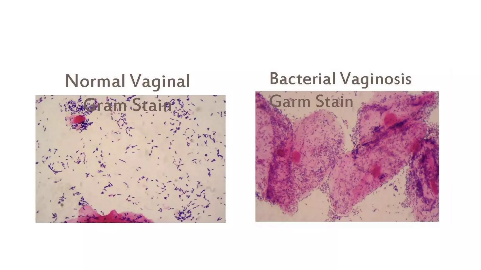 BACTERIAL VAGINOSIS final.pptx